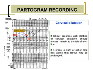 Partogram | PPT