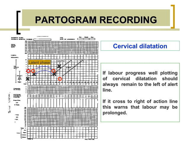 Partogram | PPT | Pregnancy | Reproductive Health