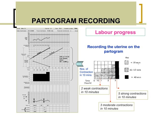 Partogram | PPT | Pregnancy | Reproductive Health