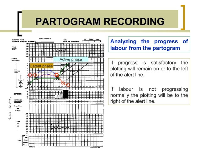 Partogram | PPT | Pregnancy | Reproductive Health