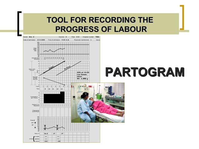 Partogram | PPT | Pregnancy | Reproductive Health