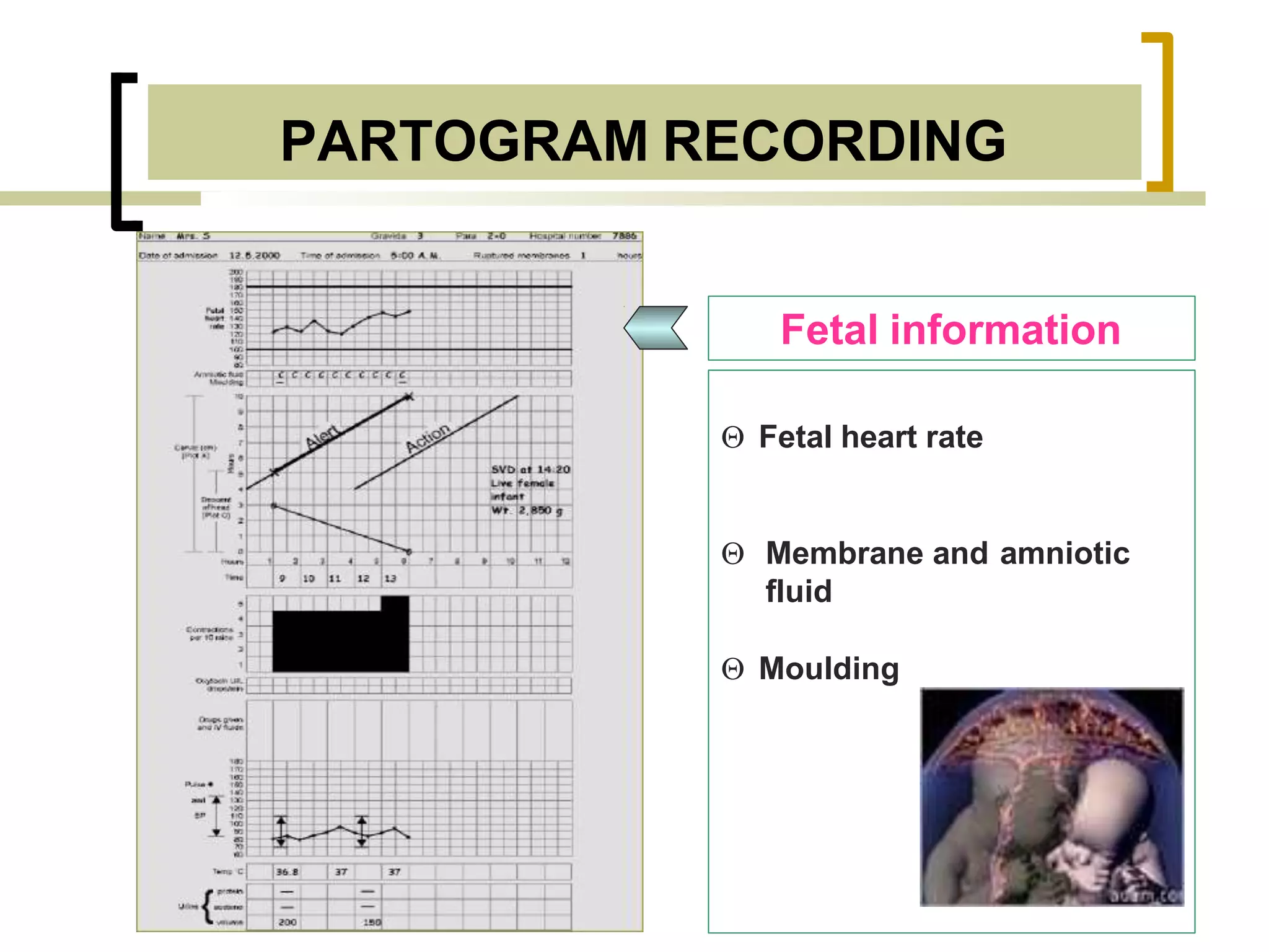 PARTOGRAM.pptx | Pregnancy | Reproductive Health