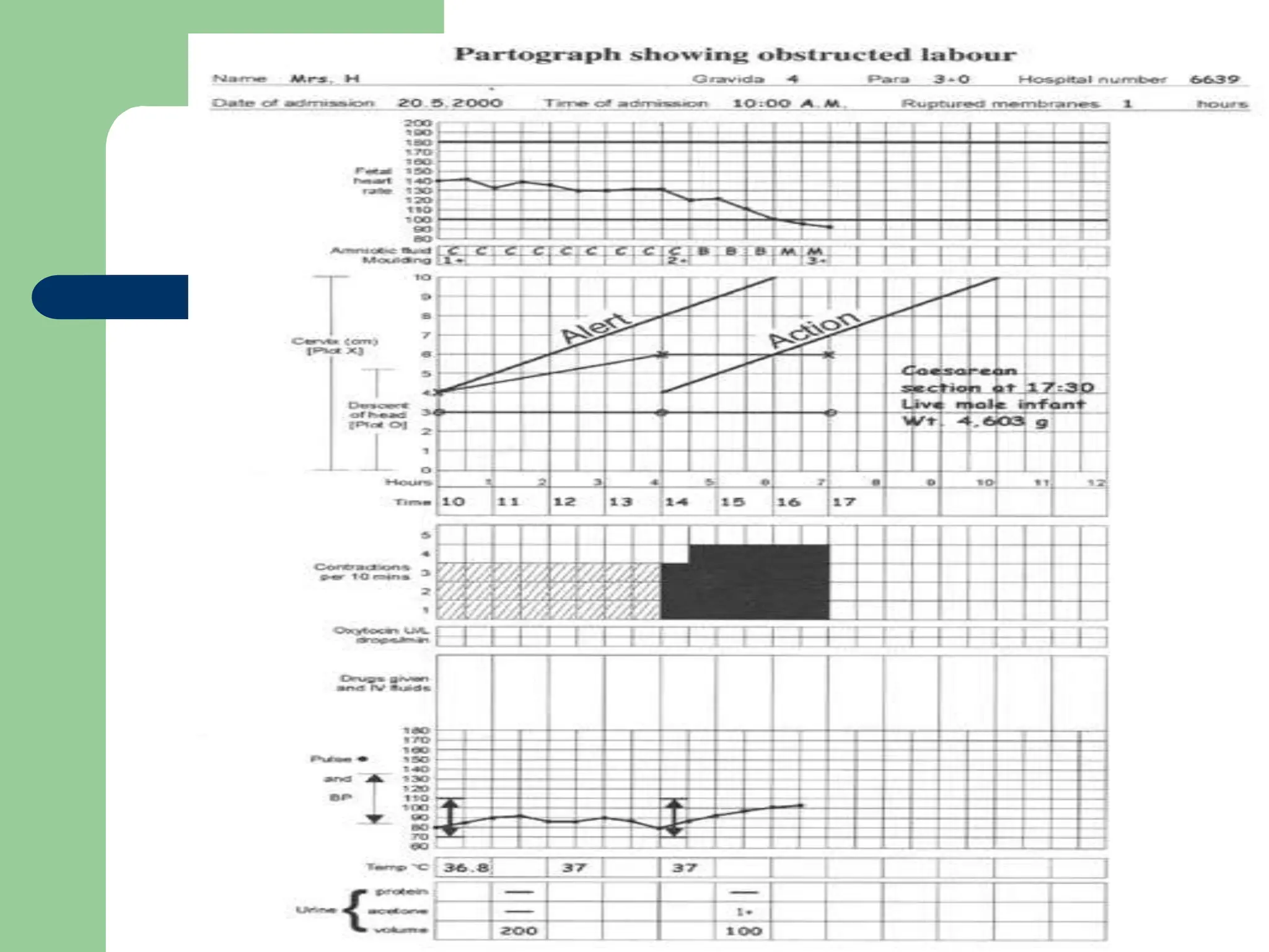 Partogram.ppt its components role of nurse while using partogram ...