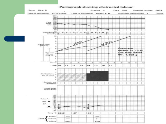 Partogram.ppt its components role of nurse while using partogram ...