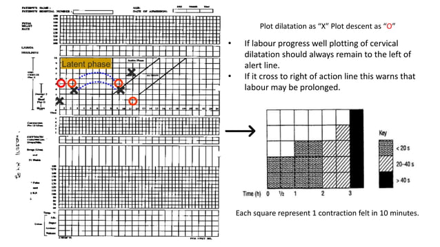 Partogram and management of 1st and 2nd stages of labor