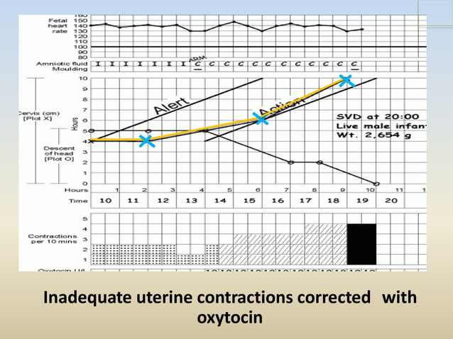 Partogram by Dr Uttara Gupta | PPT