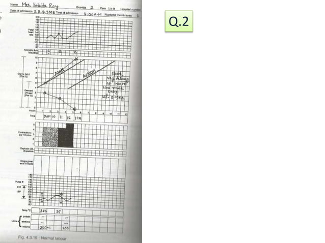 Partograph- Made easy for undergraduates | PPTX | Pregnancy ...
