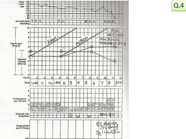 Partograph- Made easy for undergraduates | PPTX | Pregnancy ...