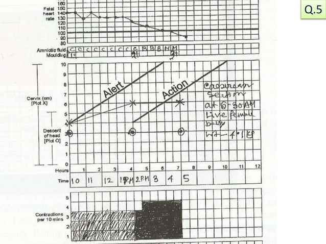 Partograph- Made easy for undergraduates | PPTX | Pregnancy ...