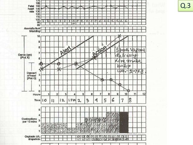 Partograph- Made easy for undergraduates
