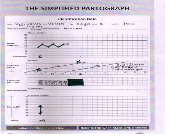 Partograph | PPTX
