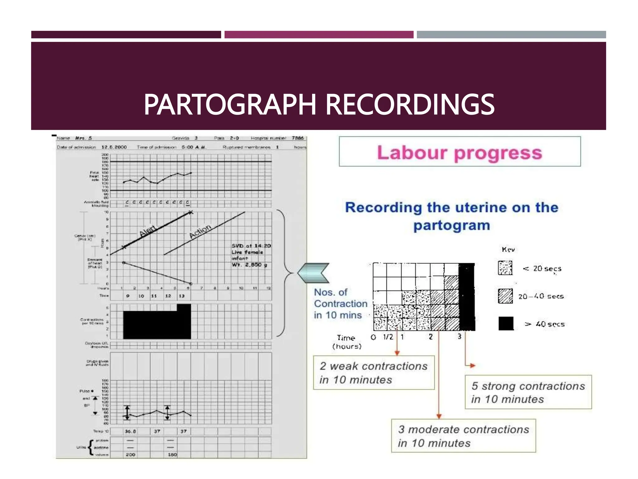 Partograph.pptx Partograph Partograph Partograph | PPTX