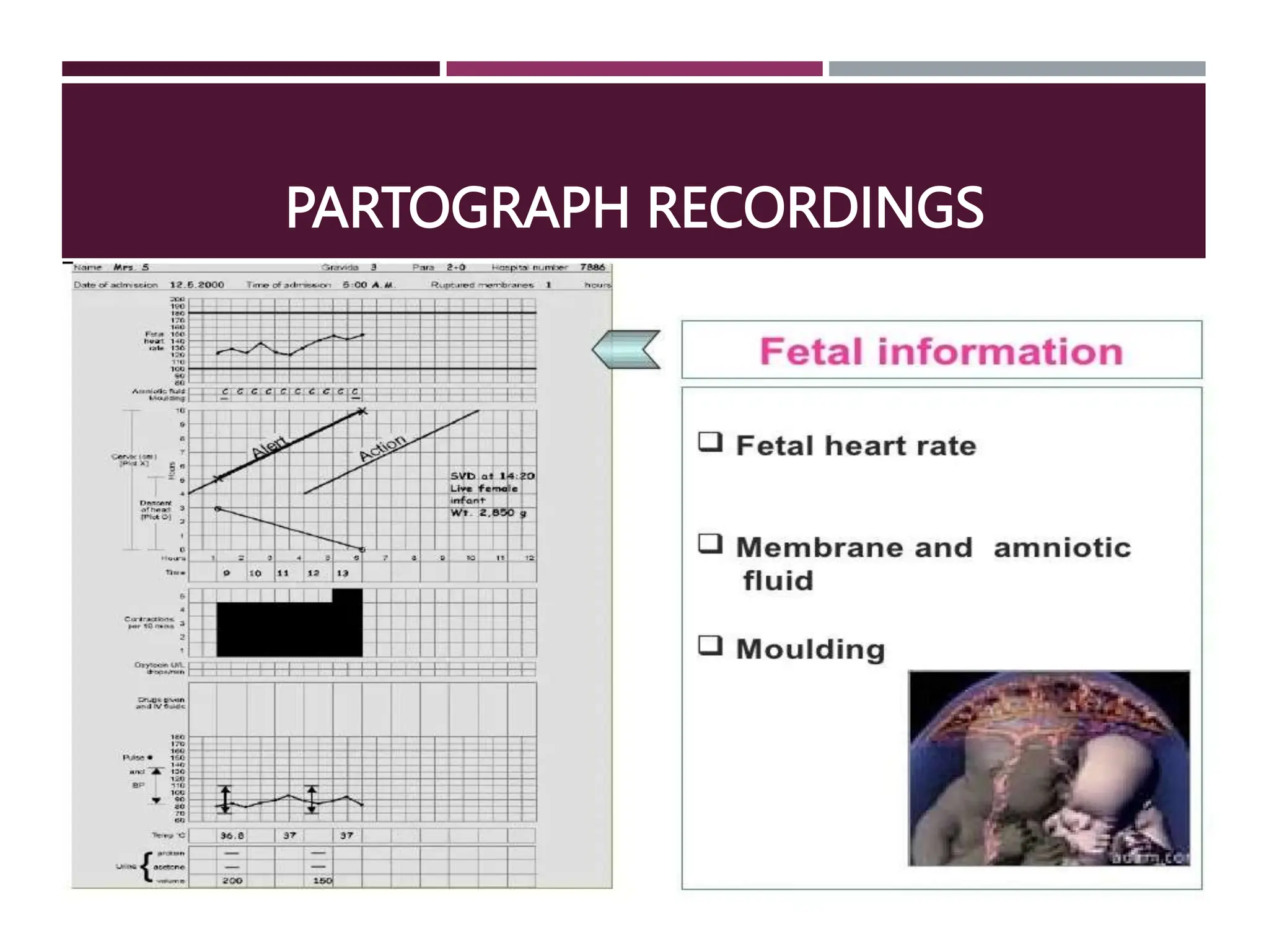Partograph.pptx Partograph Partograph Partograph | PPTX