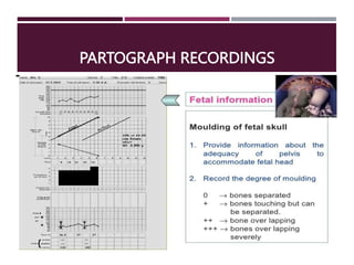 Partograph.pptx Partograph Partograph Partograph | PPTX