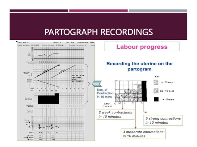 Partograph.pptx Partograph Partograph Partograph | PPTX | Pregnancy ...