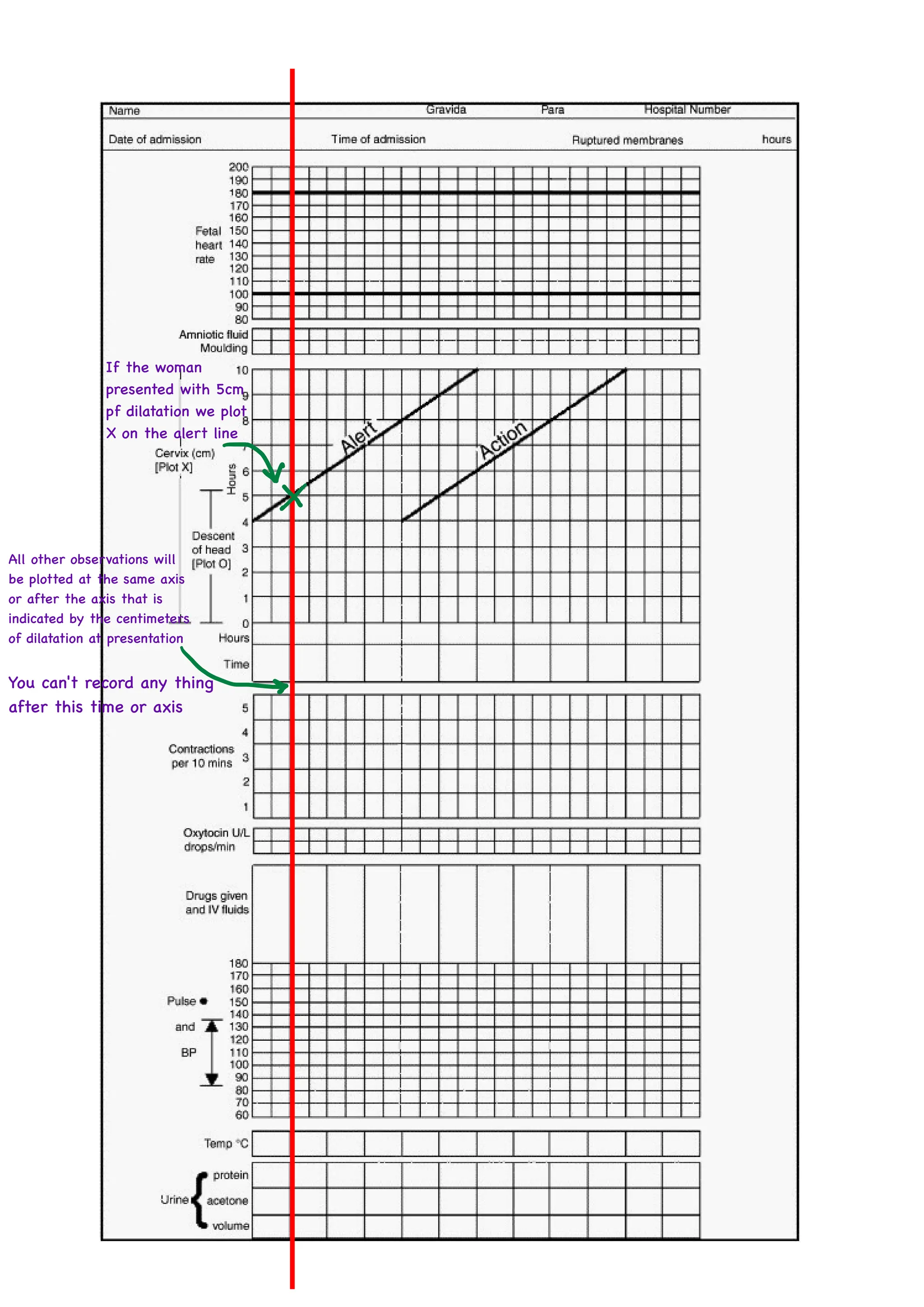 partograph gynecology medical lecture for students | PDF