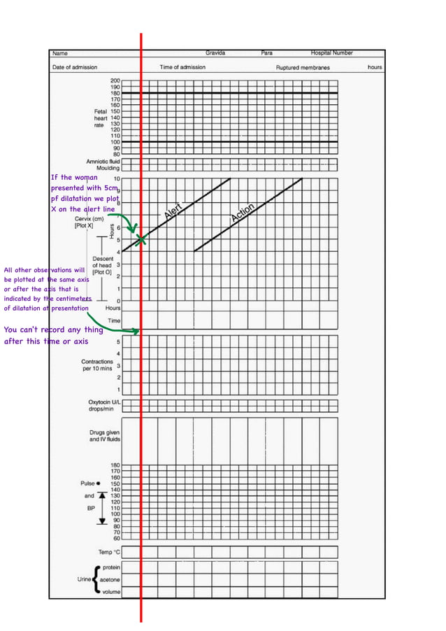 partograph gynecology medical lecture for students | PDF | Pregnancy ...