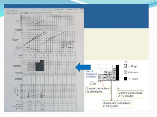 partograph in intranatal period of obstetrics | PPT