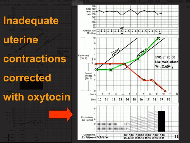partograph guide through with images included | PPT