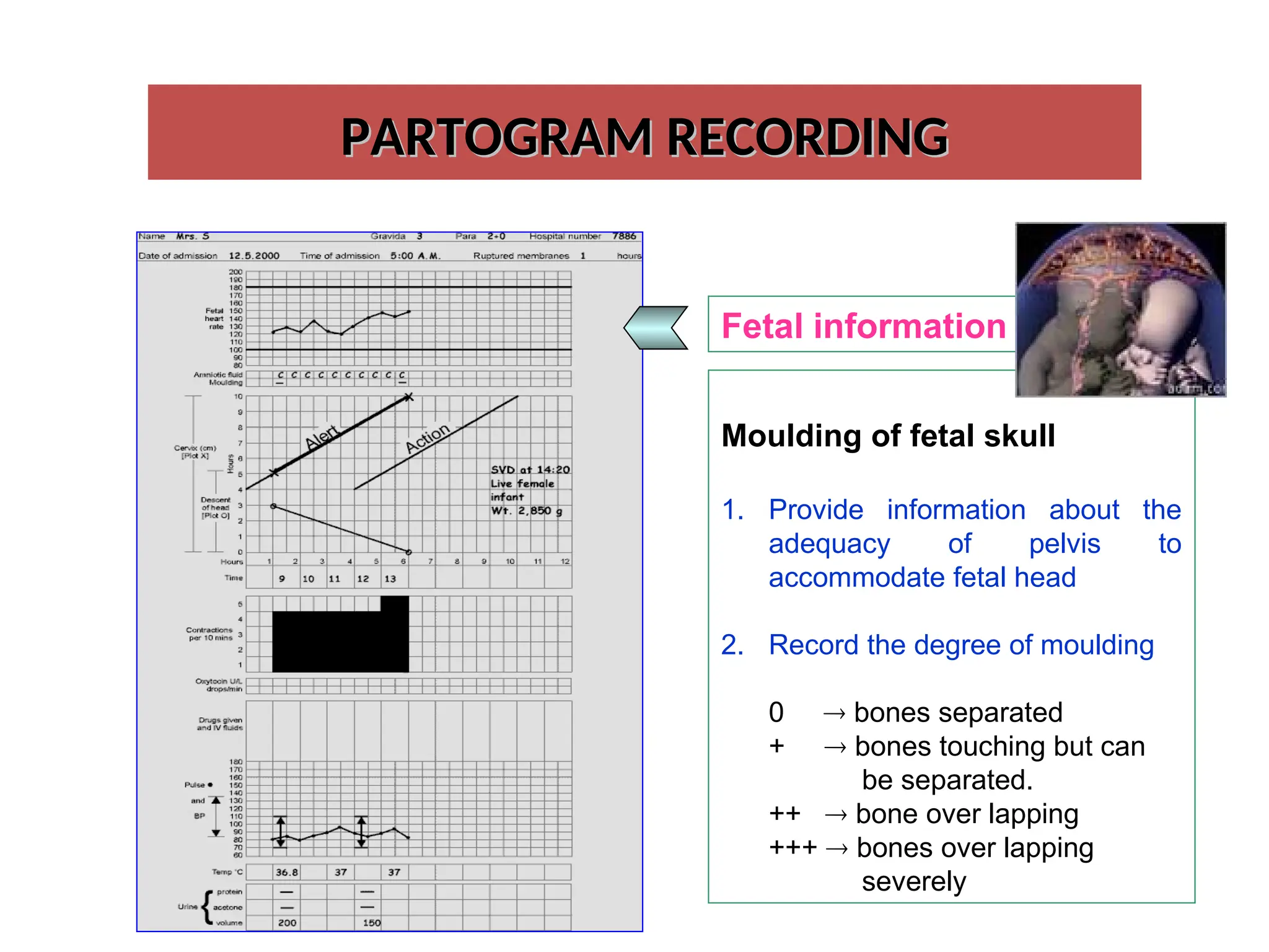PARTOGRAPH... RECORDING AND PROCESS.ppt