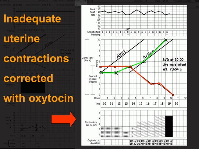 partograph.pptxxxxxxxxxxxxxxxxxxxxxxxxxx | PPT