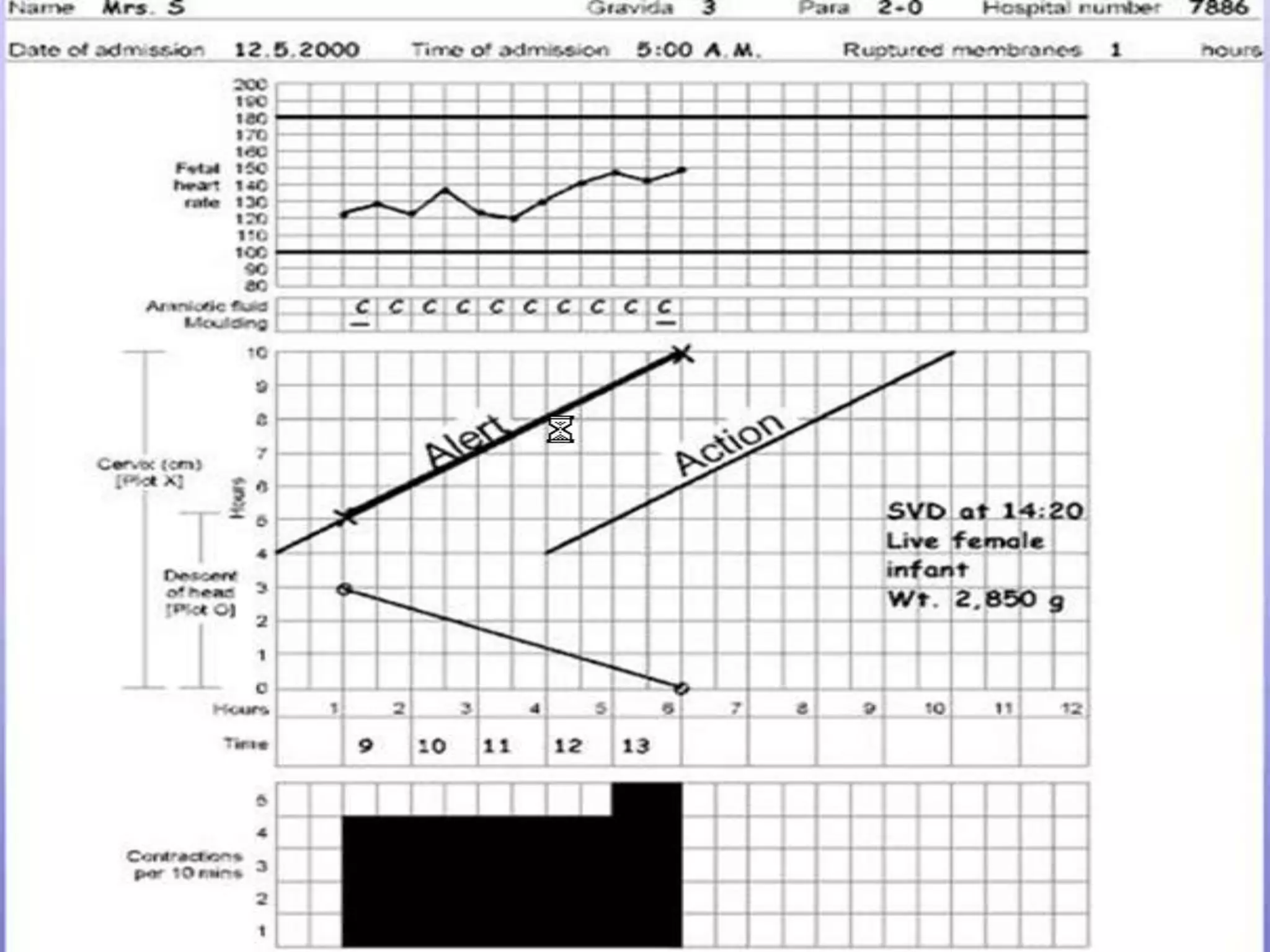 LABOUR MONITORING BY PARTOGRAPH BY DR SHASHWAT JANI | PPTX