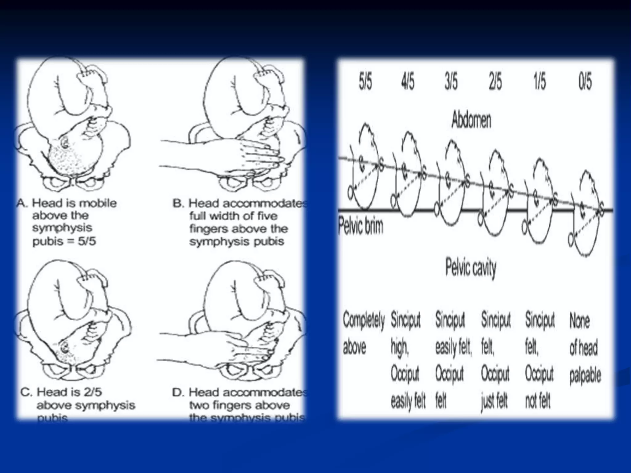 LABOUR MONITORING BY PARTOGRAPH BY DR SHASHWAT JANI | PPTX