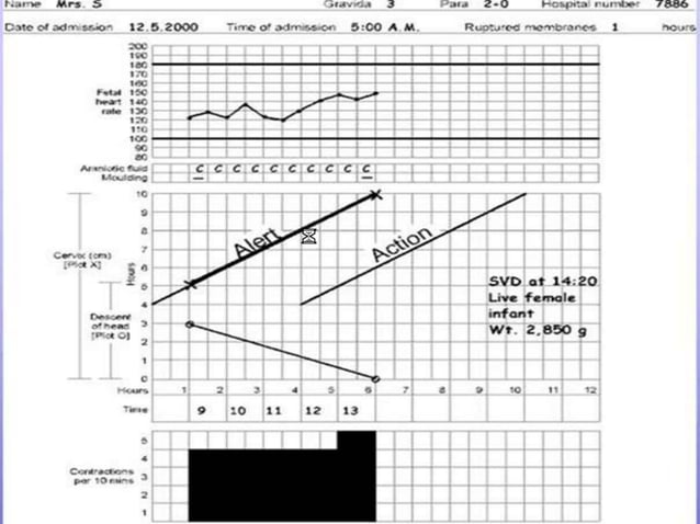 LABOUR MONITORING BY PARTOGRAPH BY DR SHASHWAT JANI | PPTX | Pregnancy ...
