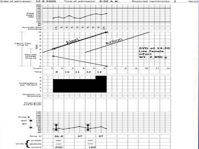 LABOUR MONITORING BY PARTOGRAPH BY DR SHASHWAT JANI | PPTX | Pregnancy ...