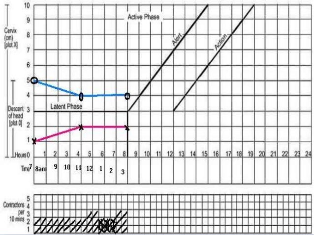 LABOUR MONITORING BY PARTOGRAPH BY DR SHASHWAT JANI