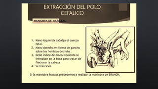 parto pélvico. Y sus mecanismos y maniobras | PPTX