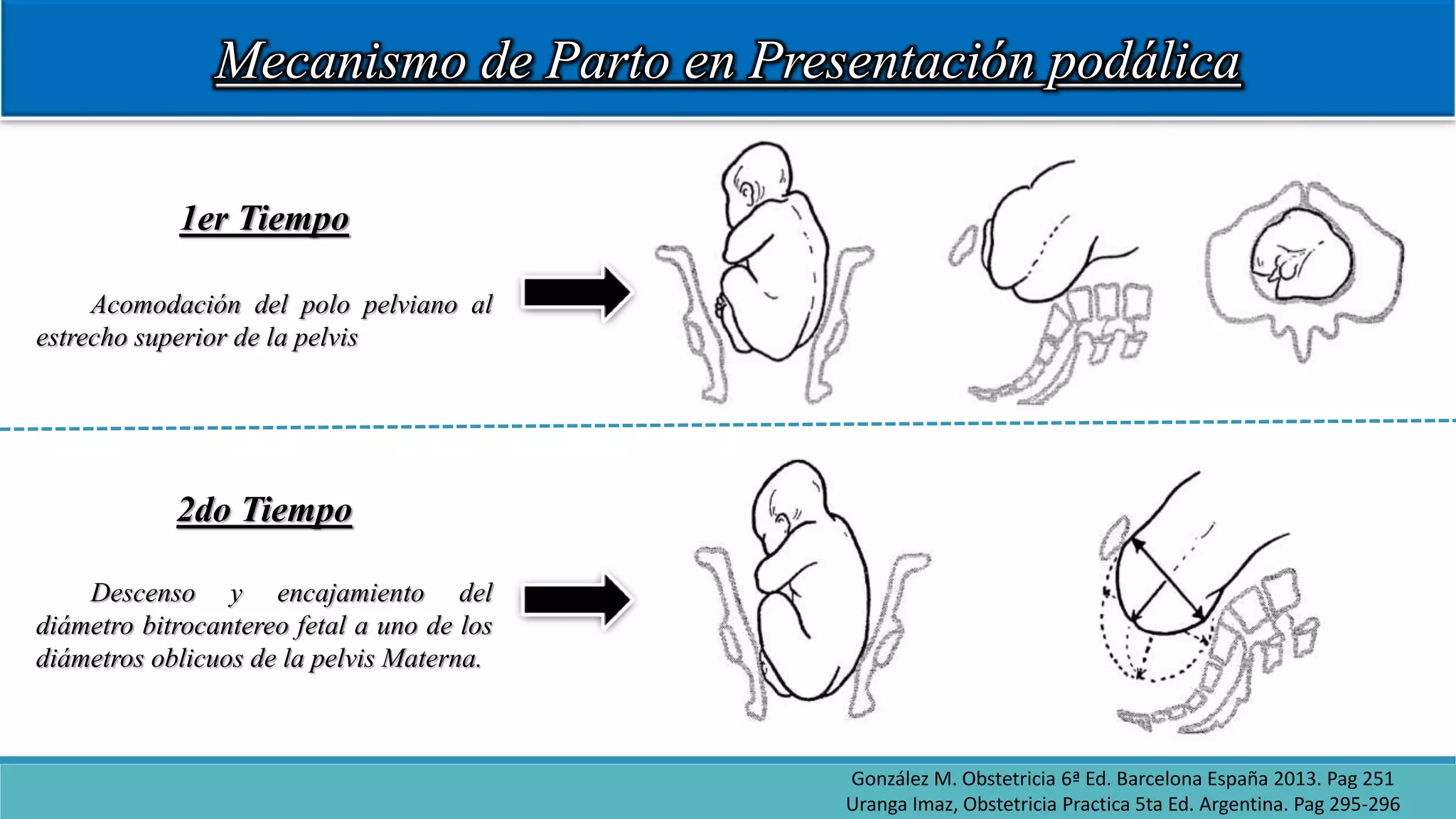 Parto podalico | PPTX