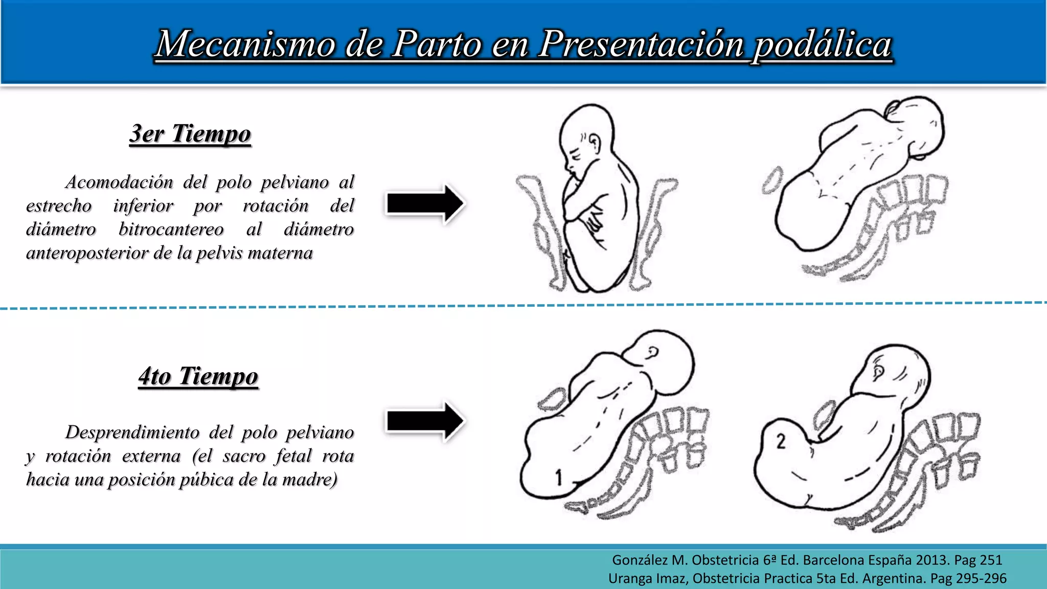Parto podalico | PPTX