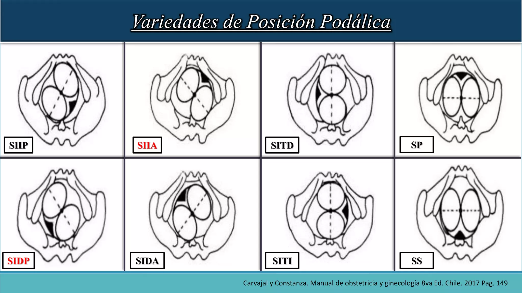 Parto podalico | PPT