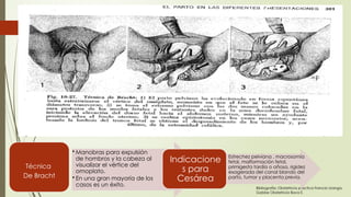 parto podalico. Tecnicas y mecanismo del parto | PPTX