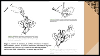 PARTO VAGINAL INSTRUMENTADO R1 SALAS.pptx