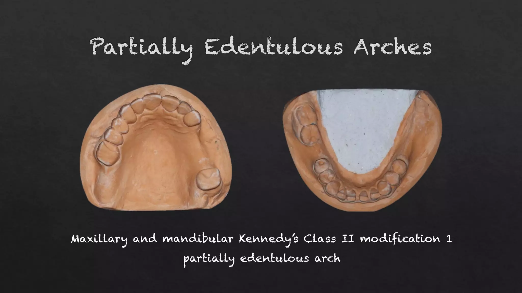 Parts of Cast Partial Dentures | PDF