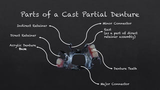 Parts of Cast Partial Dentures | PDF