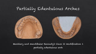Parts of Cast Partial Dentures | PDF