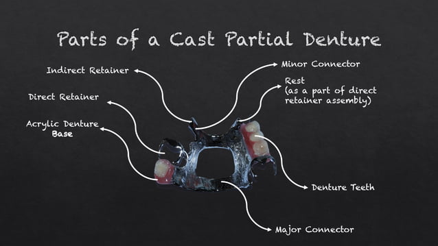 Parts of Cast Partial Dentures | PPT