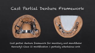 Mandibular Partial Denture