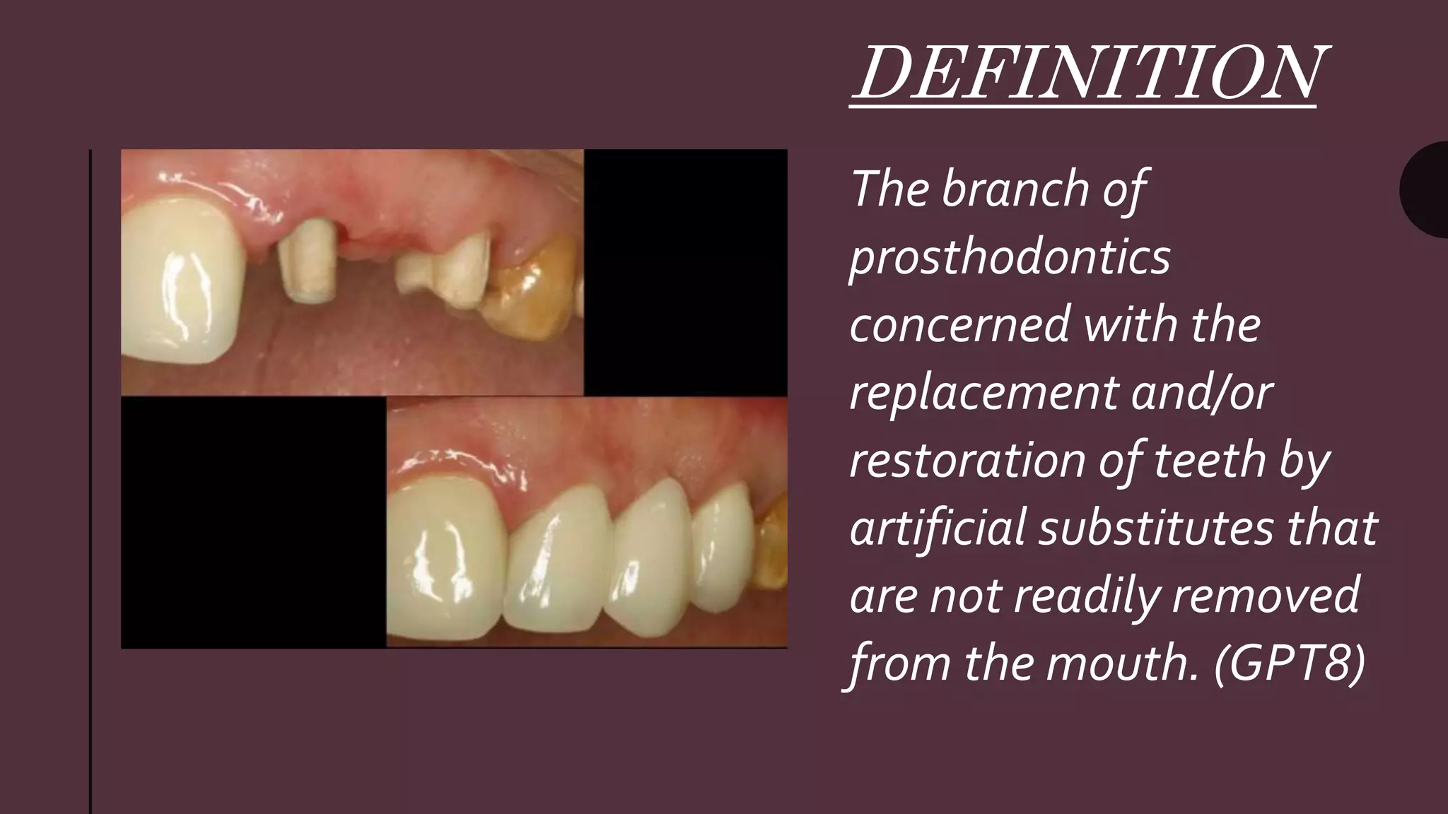 Parts of fixed partial denture | PPTX