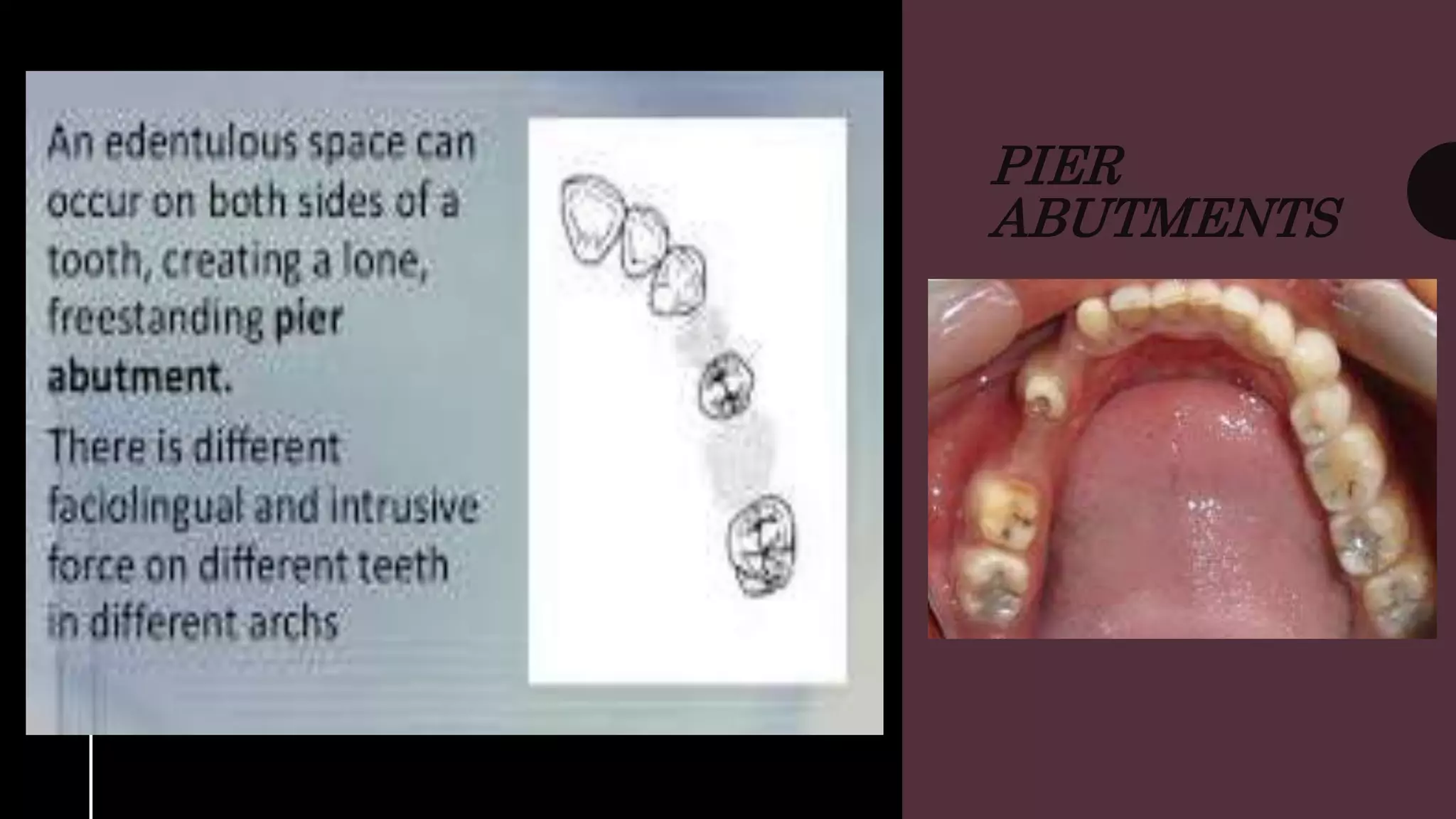 Parts of fixed partial denture | PPTX