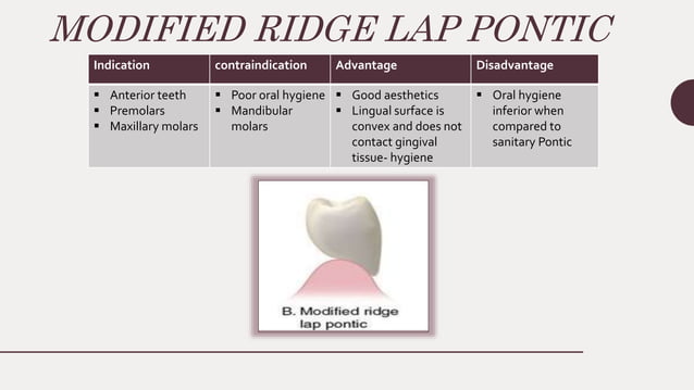 Parts of fixed partial denture | PPTX | Dental Health | Diseases and ...