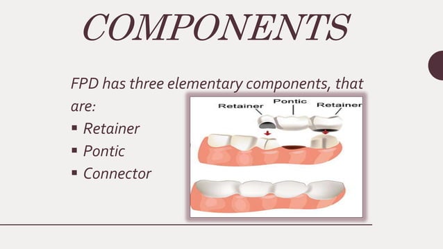 Parts of fixed partial denture | PPTX | Dental Health | Diseases and ...