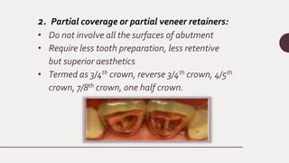 Parts of fixed partial denture | PPTX