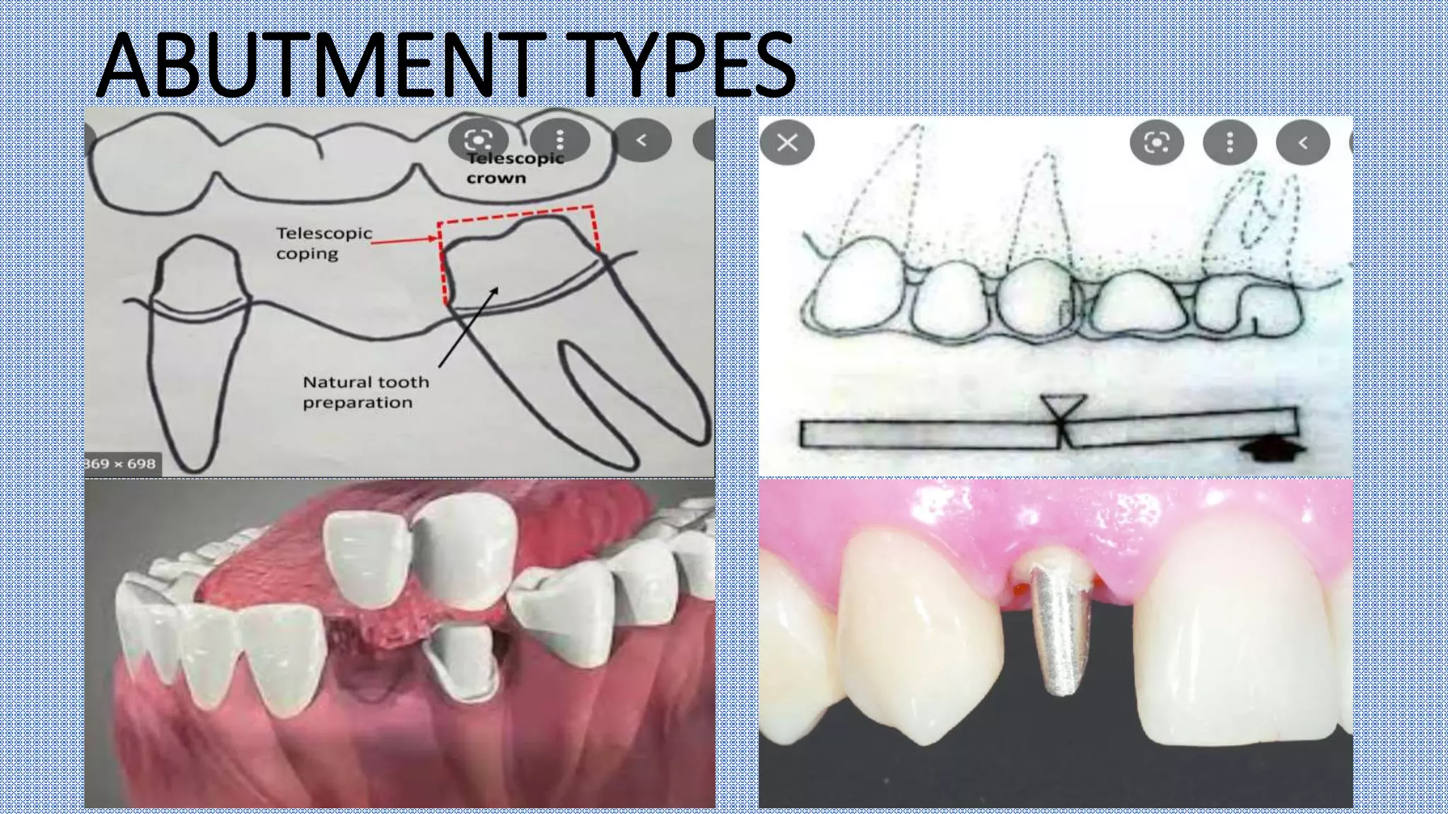 PARTS OF FIXED PARTIAL DENTURE.pptx