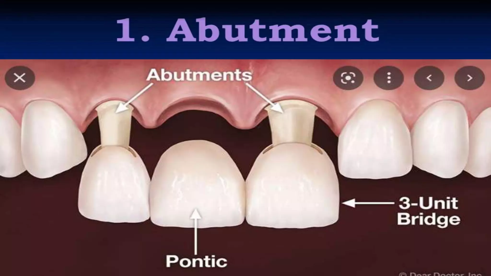 PARTS OF FIXED PARTIAL DENTURE.pptx