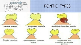 PARTS OF FIXED PARTIAL DENTURE.pptx