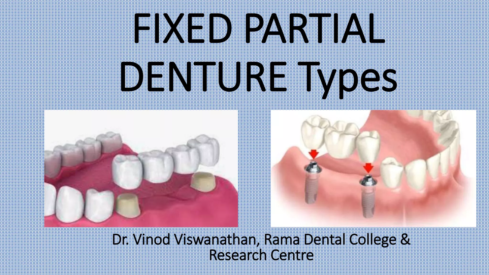 PARTS OF FIXED PARTIAL DENTURE.pptx